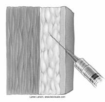 Immunization Injection Site Infection